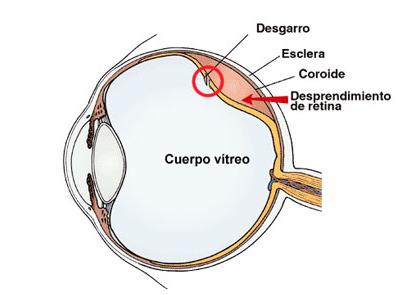 Desprendimiento de retina - Òptica Fàbregas